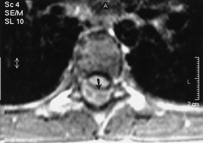 Spinal Epidural Abscess - Spine - Orthobullets